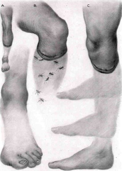 Telescoping Phantom Limb