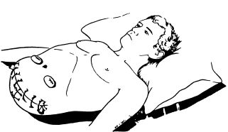 Translumbar Amputation