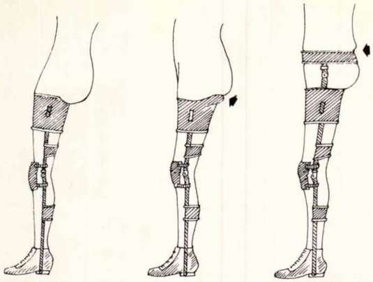 Figure 2 Long Leg Braces With Modifications Fo Oandp Digital Resource Library