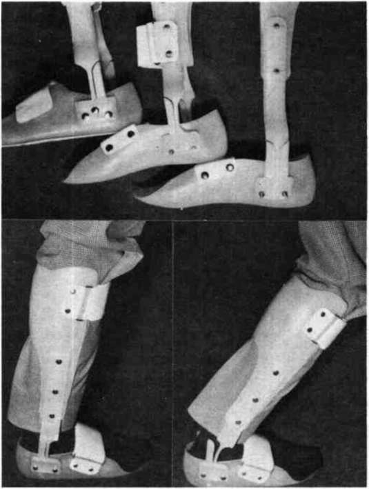 Fig. 2. Top, ankle joints showing plantarflexi | O&P Digital Resource ...